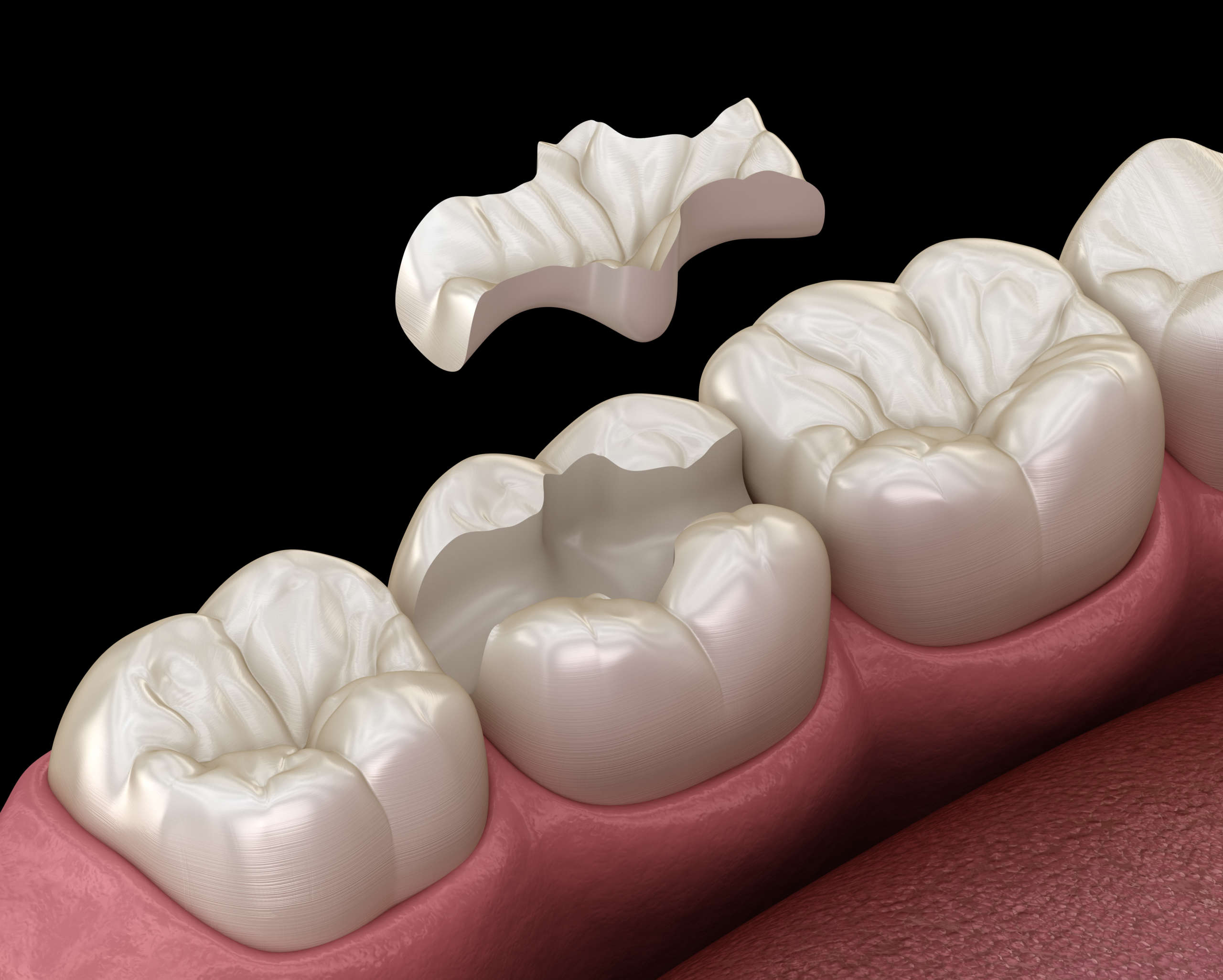 MA Dental Inlay Restorations: What You Need To Know - Prime Smile ...